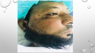 Infratemporal space infection | PPT