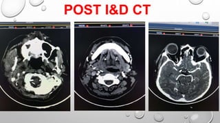 Infratemporal space infection | PPT