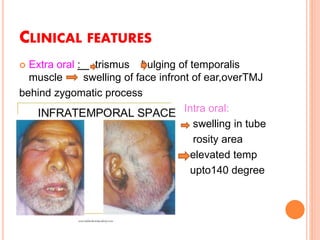 Infratemporal Space Infection