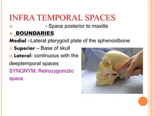Infratemporal Space Infection