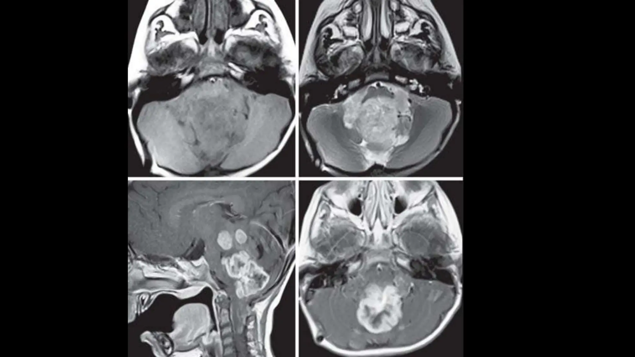 IMAGING OF INFRATENTORIAL BRAIN TUMORS.pptx
