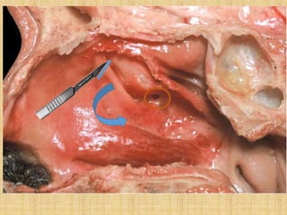 Infundibulotomy & Maxillary sinusotomy pg | PPT
