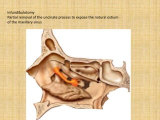 Infundibulotomy & Maxillary sinusotomy pg | PPT