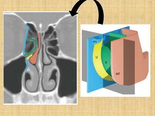 Infundibulotomy & Maxillary sinusotomy pg | PPT