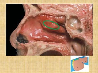 Infundibulotomy & Maxillary sinusotomy pg | PPT