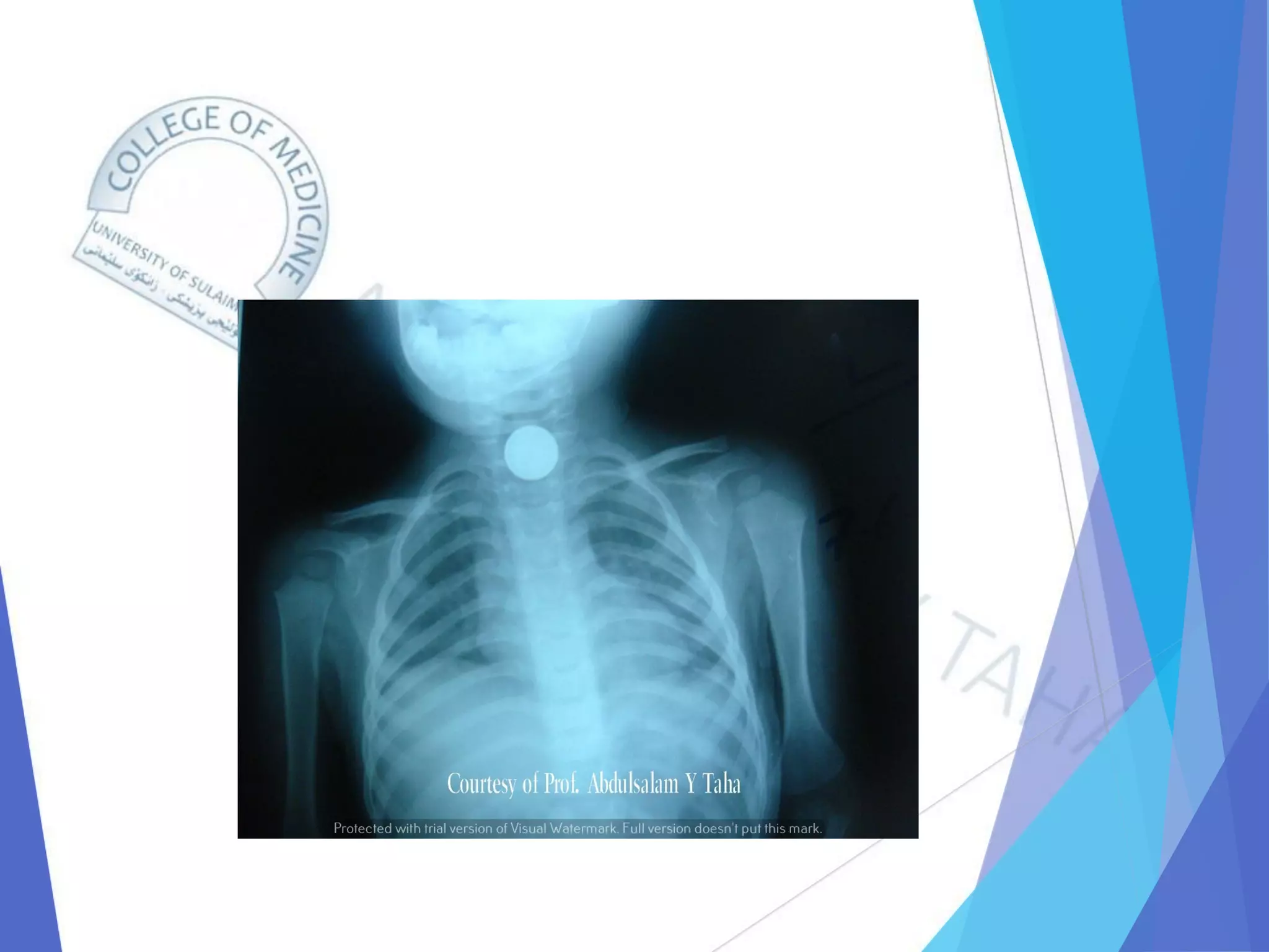 Ingestion of A Watch Battery.pdf | Ear, Nose and Throat Conditions ...