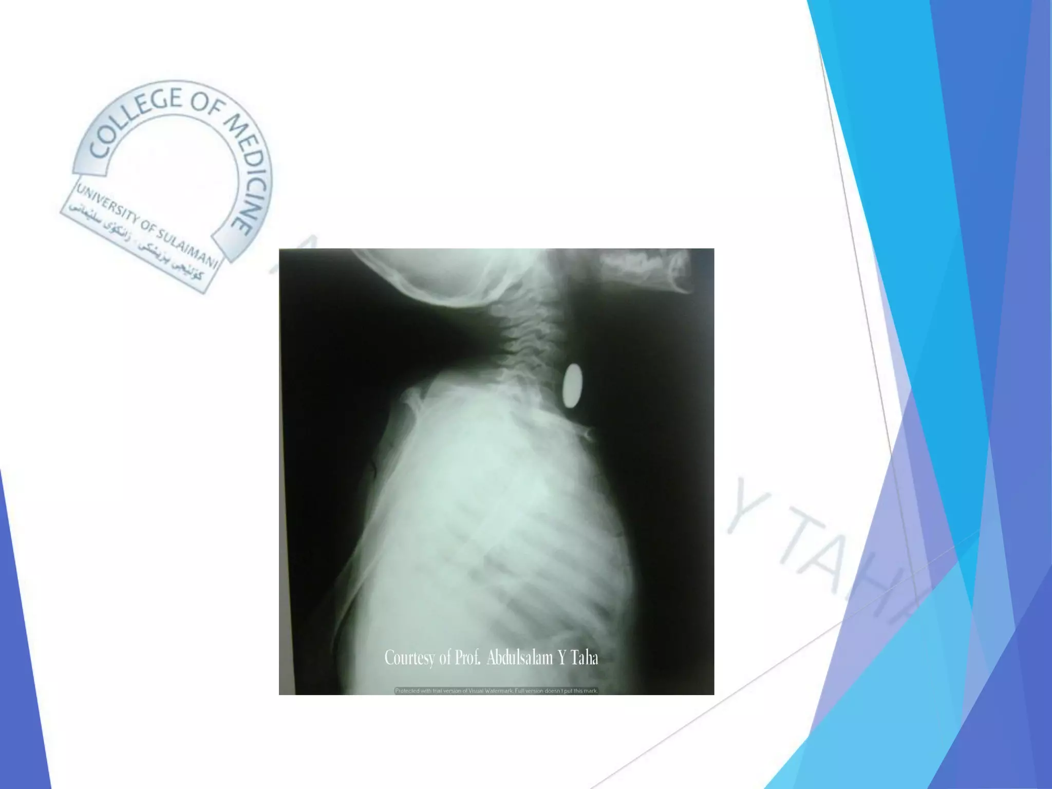 Ingestion of A Watch Battery.pdf | Ear, Nose and Throat Conditions ...