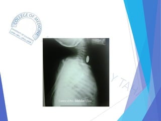 Ingestion of A Watch Battery.pdf | Ear, Nose and Throat Conditions ...