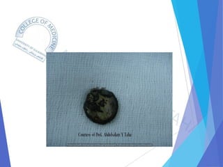 Ingestion of A Watch Battery.pdf | Ear, Nose and Throat Conditions ...