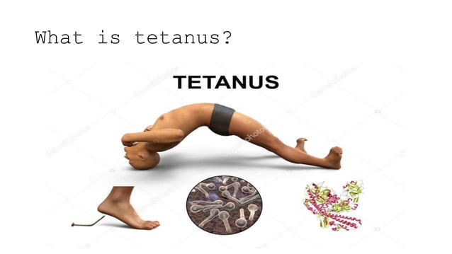 Tetanus, symptoms, prevention, treatment. | PPTX