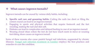 Ingrown Toenail Surgery in London- the Safest way to cure ingrown nail ...