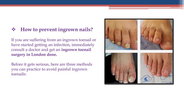 Ingrown Toenail Surgery in London- the Safest way to cure ingrown nail ...