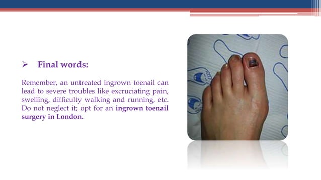 Ingrown Toenail Surgery in London- the Safest way to cure ingrown nail ...