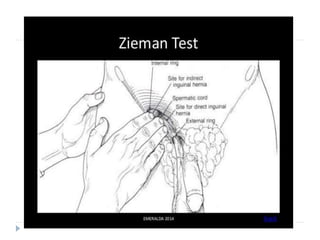 Inguinal and Femoral hernia | PPTX