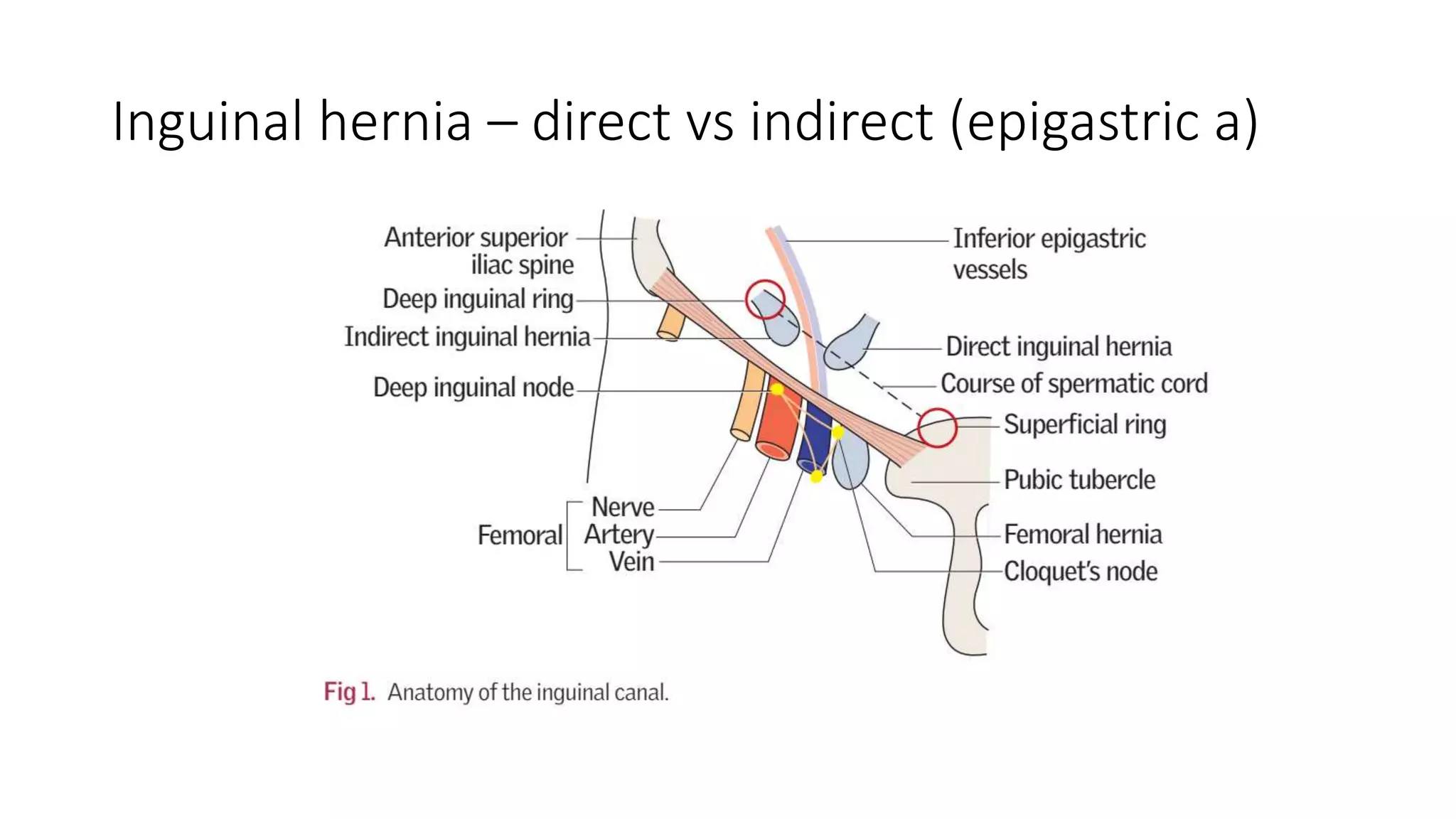 Inguinal and femoral hernia | PPTX