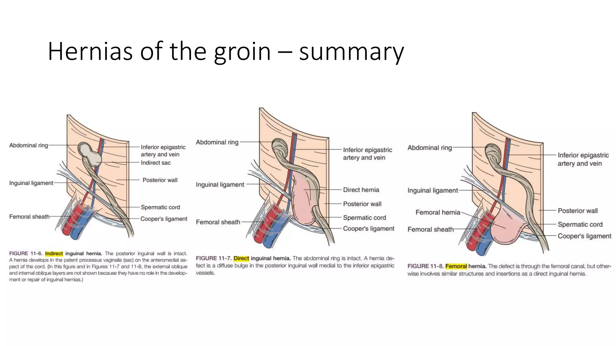 Inguinal and femoral hernia | PPTX