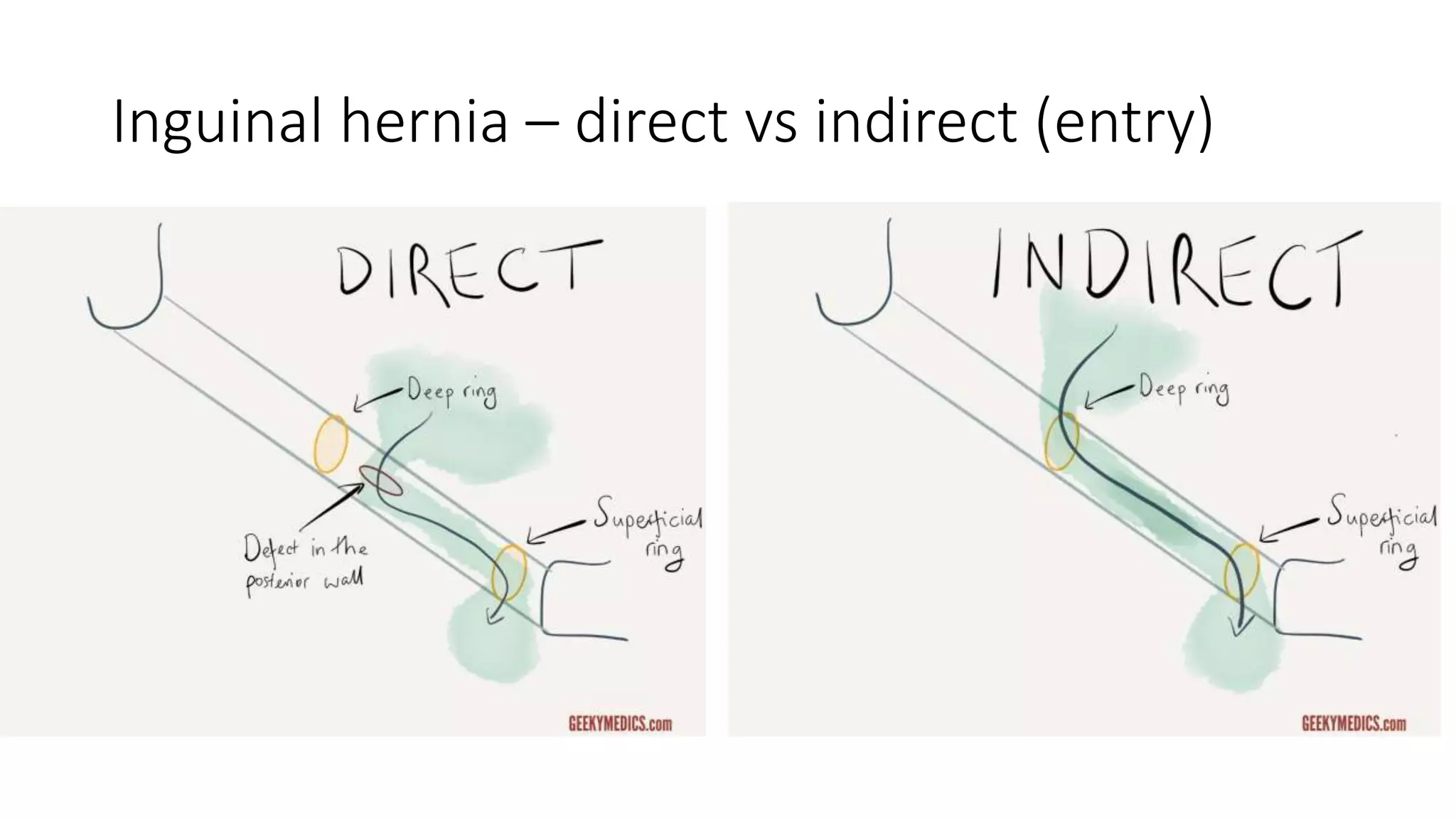 Inguinal and femoral hernia | PPTX