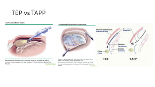 Inguinal and femoral hernia | PPTX