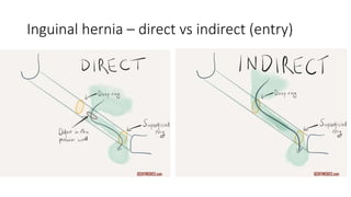 Direct Vs Indirect Hernia