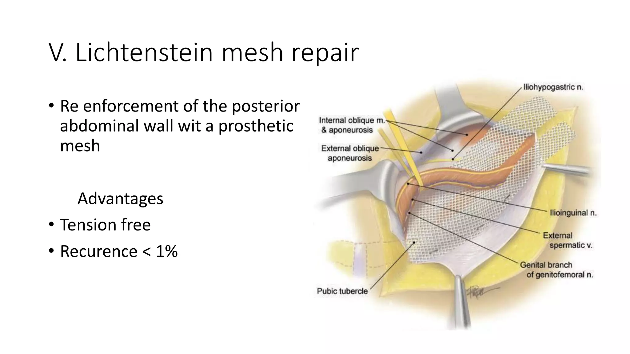 INGUINAL & FEMORAL HERNIA.pdf