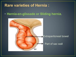 Sliding Inguinal Hernia