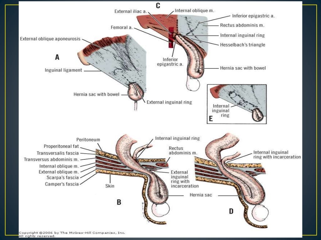 Inguinal hernia ppt