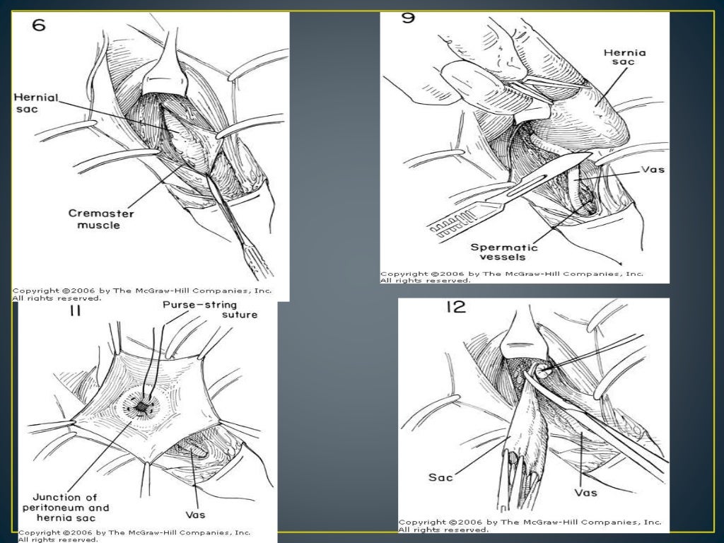 Inguinal hernia ppt