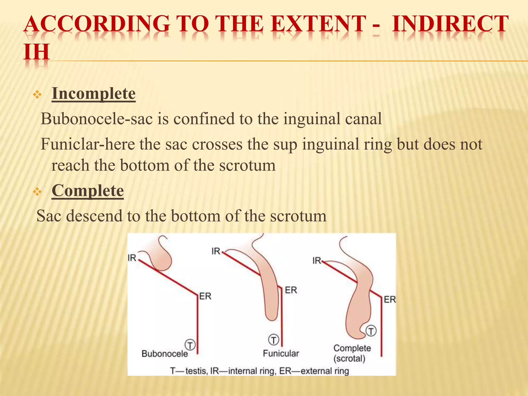 Inguinal hernia | PPTX