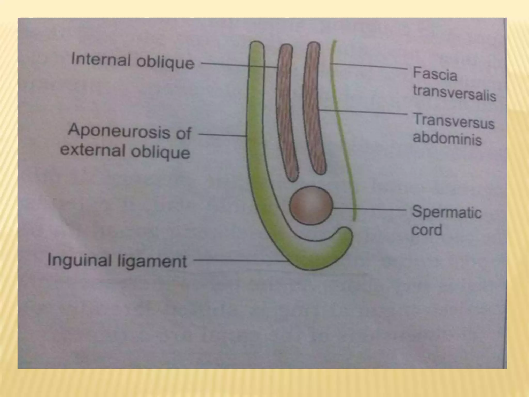 Inguinal hernia | PPTX