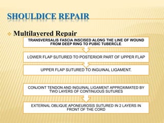 Inguinal hernia | PPT