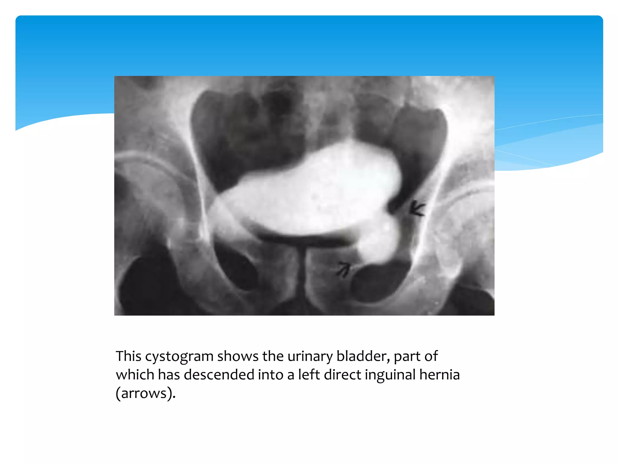 Inguinal hernia | PPTX