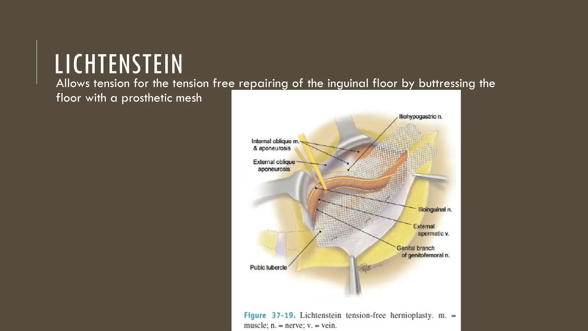 Inguinal Hernia.pptx kist general surgery | PPTX