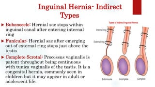 Inguinal Hernia- Groin Swellings | PPTX
