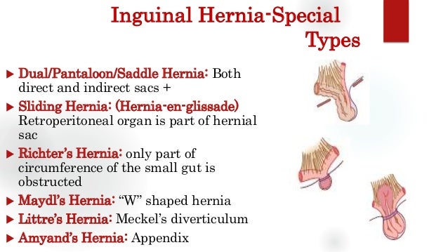 Type Ii Sliding Inguinal Hernia In This Case The