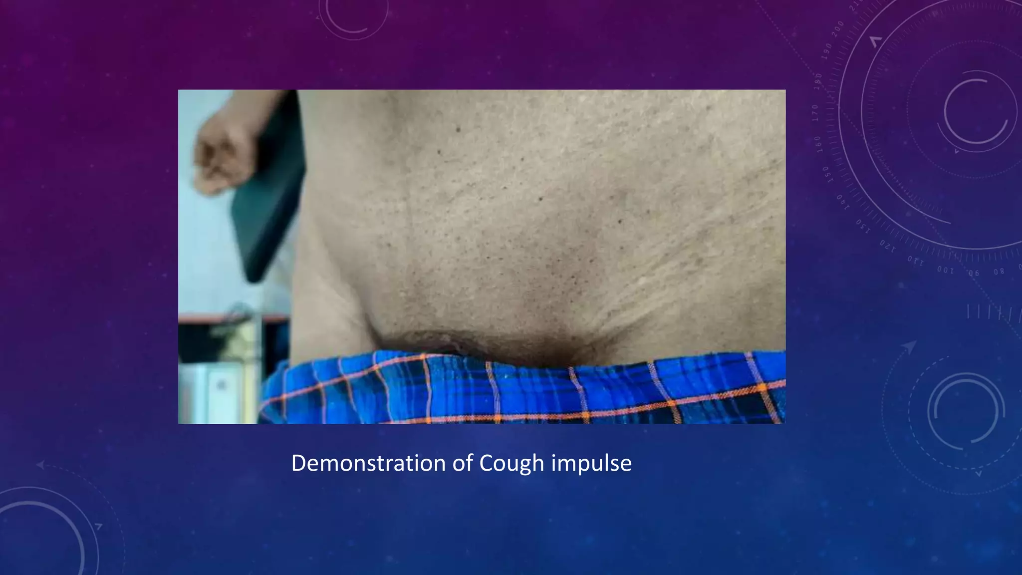 Inguinal Hernia_170522-1.pptx