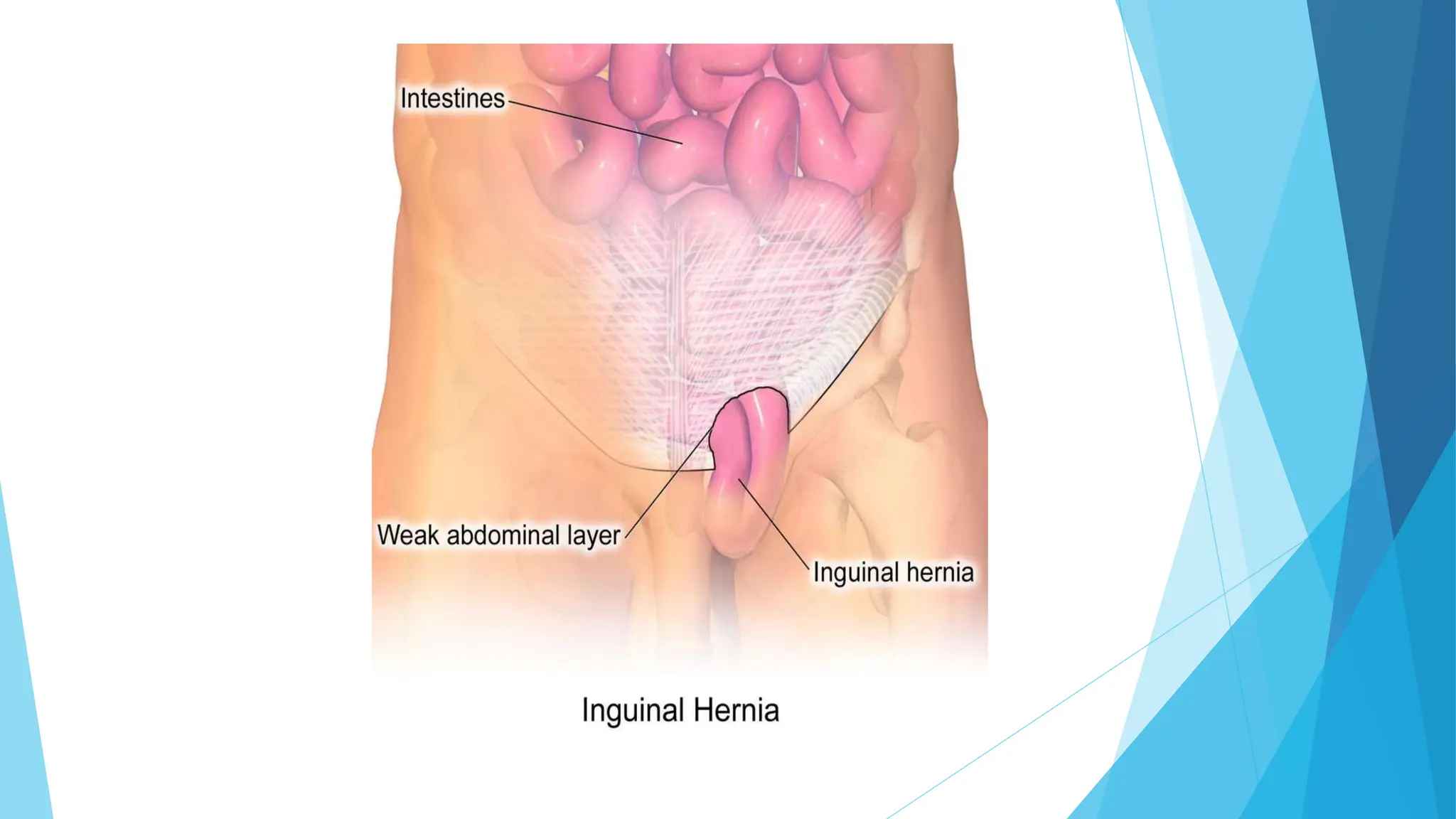 inguinal hernia 2 ,theory part for surgery .pptx | Surgery | Medical Health