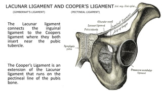 Coopers Ligament Hernia