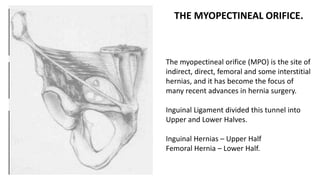 Inguinal hernia and its management | PPT