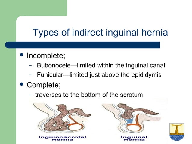 Inguinal hernia examination