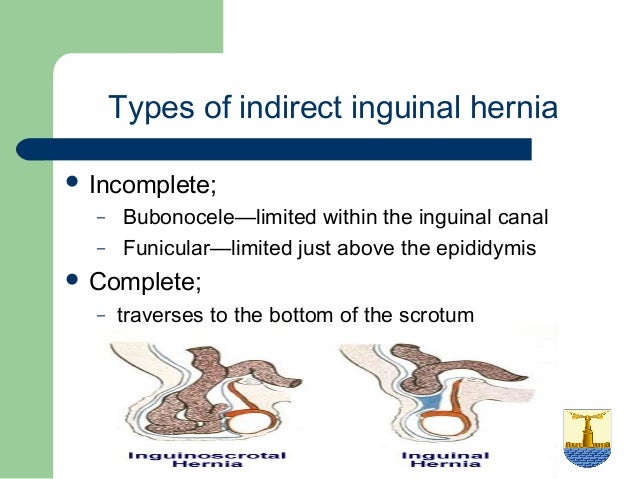 Inguinal hernia examination