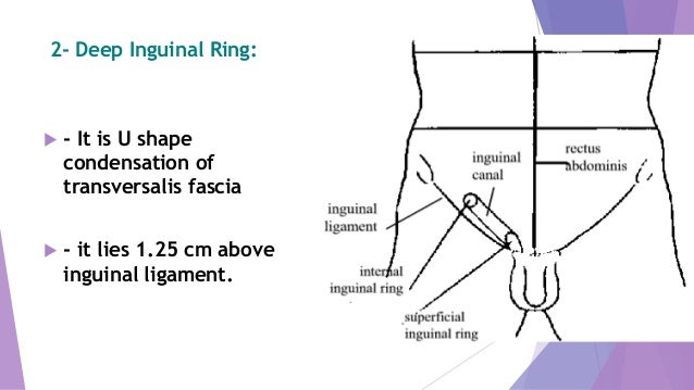 Inguinal hernia