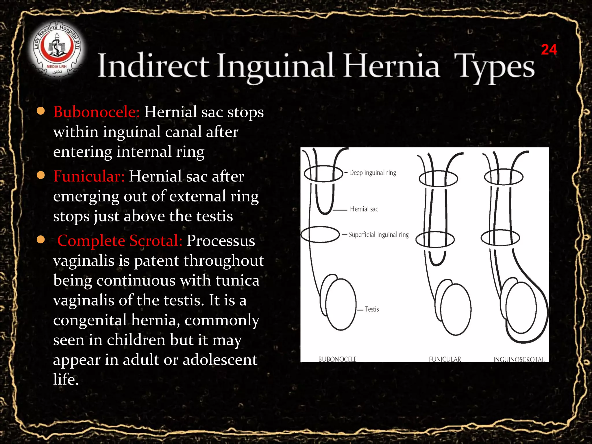 Inguinal Hernia Management, Presentation, by Dr. Shabir Ahmad | PPT | Death, Injury, or Military ...