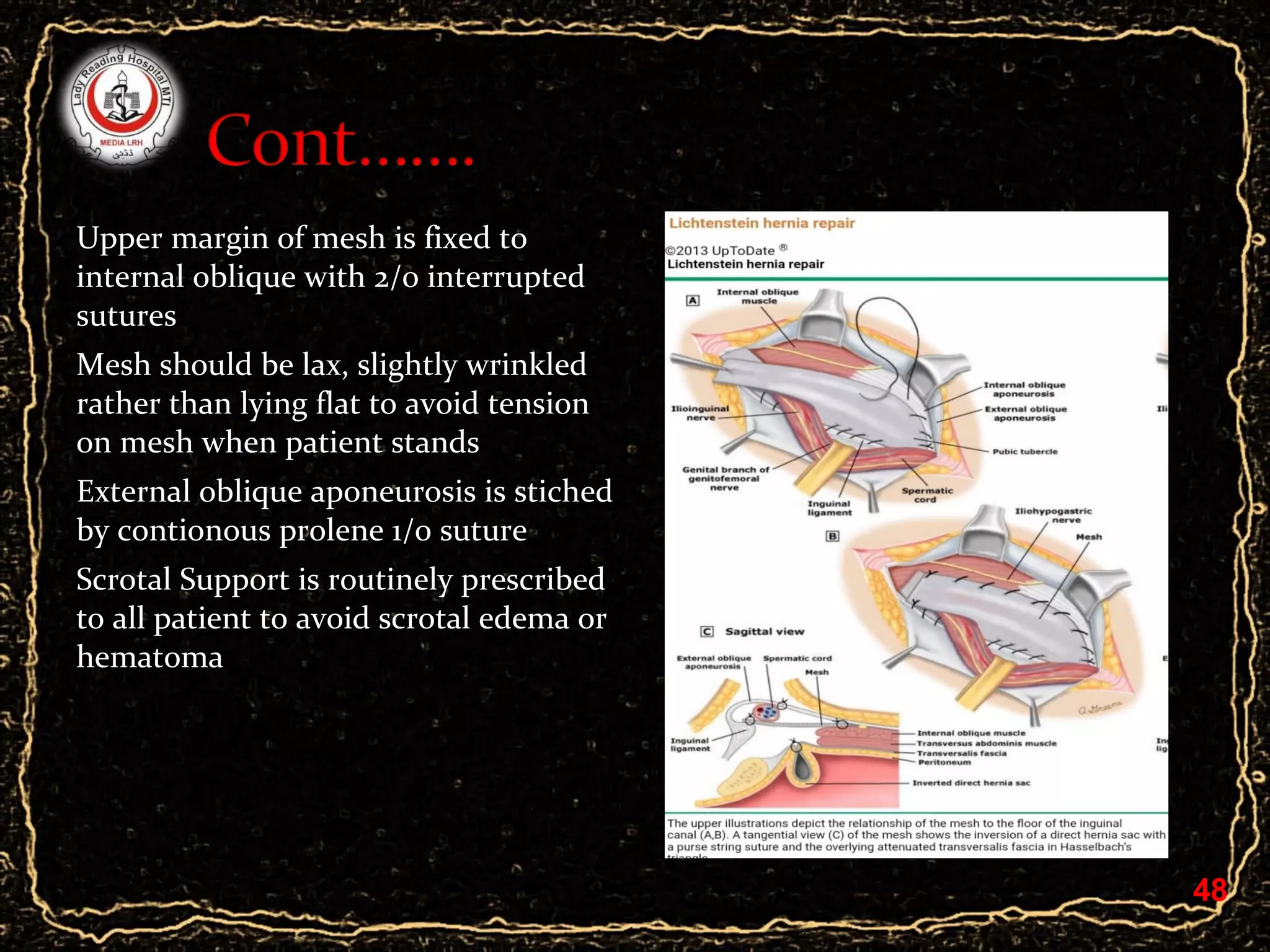 Inguinal Hernia Management, Presentation, by Dr. Shabir Ahmad | PPT