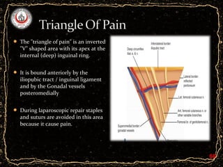Inguinal Hernia Management, Presentation, by Dr. Shabir Ahmad | PPT