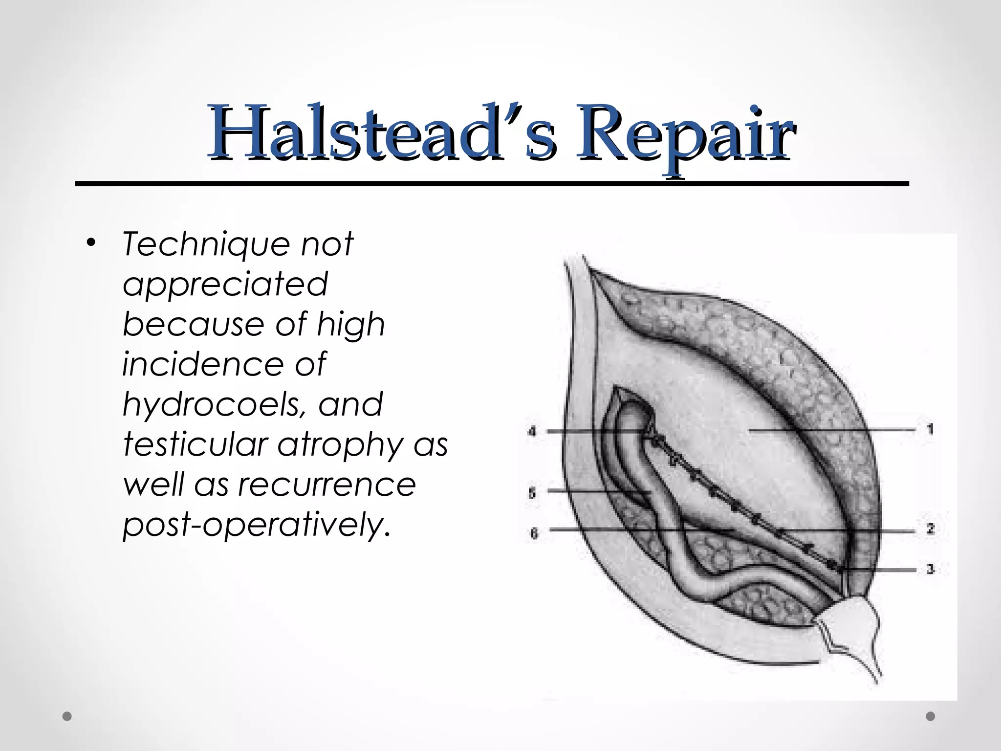 Inguinal hernia | PPT
