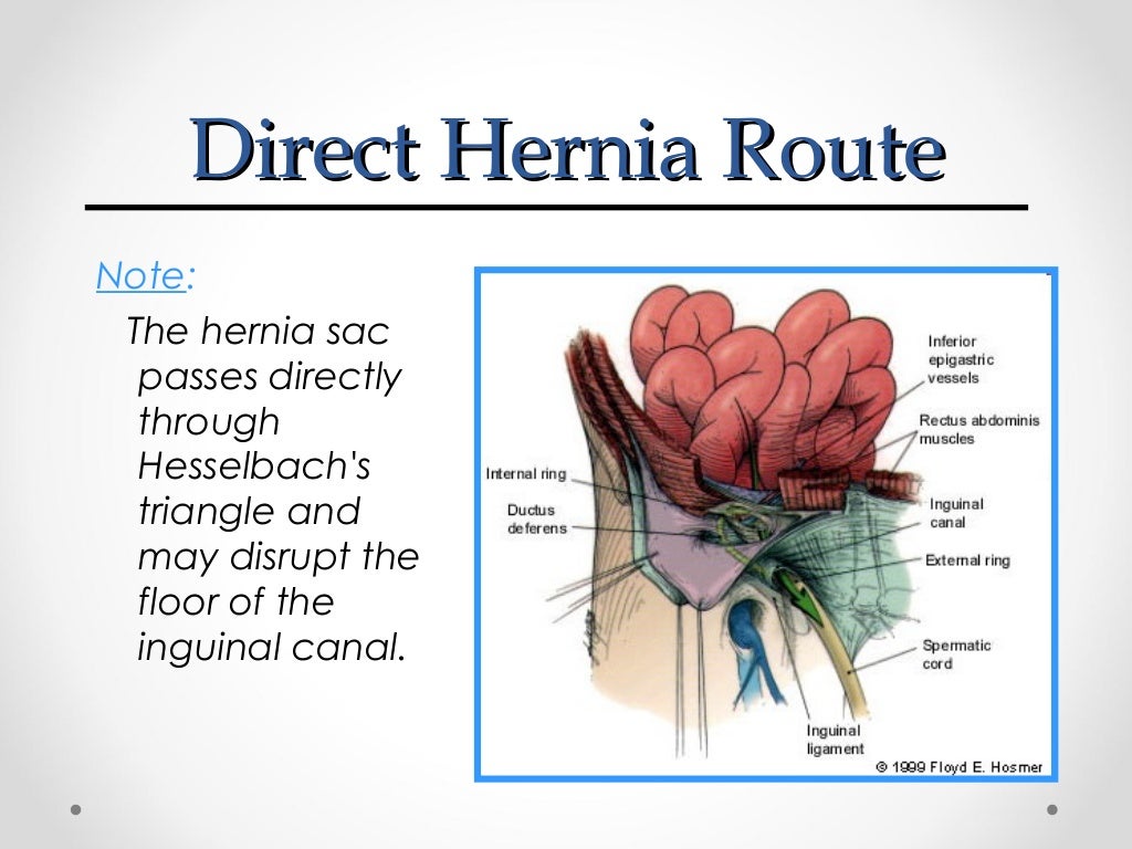 Inguinal hernia