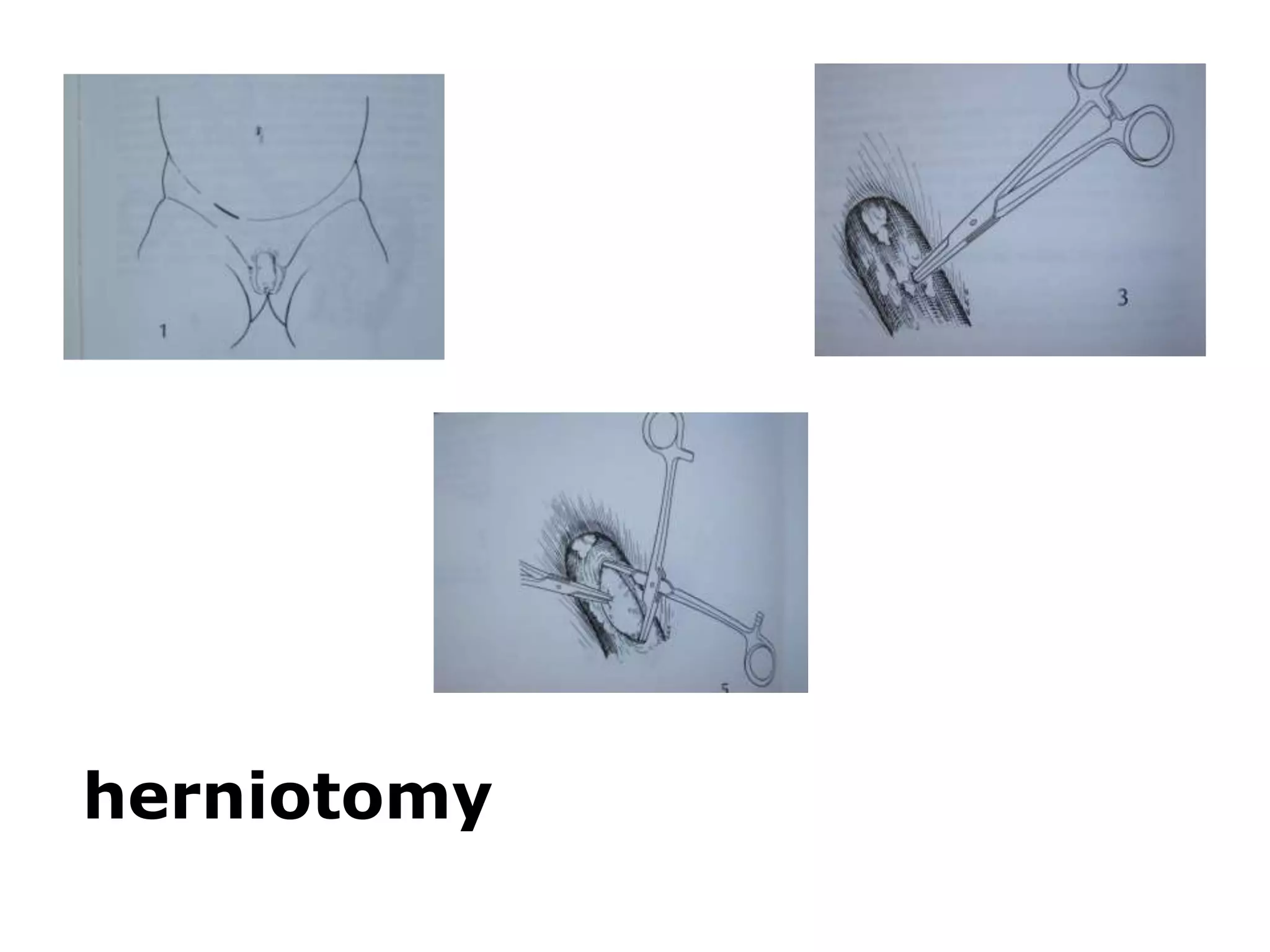 Inguinal hernia repair | PPTX