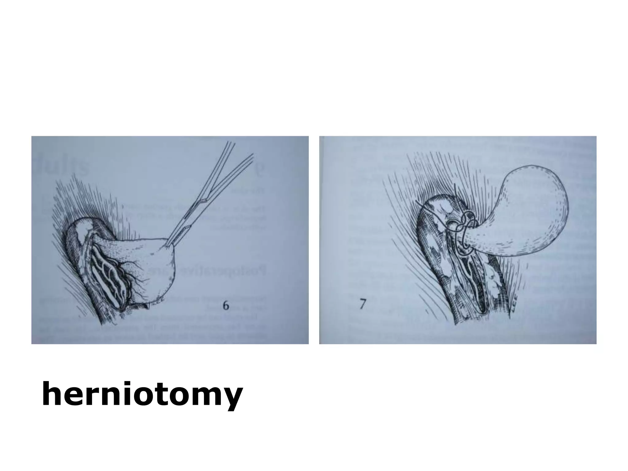 Inguinal hernia repair | PPTX