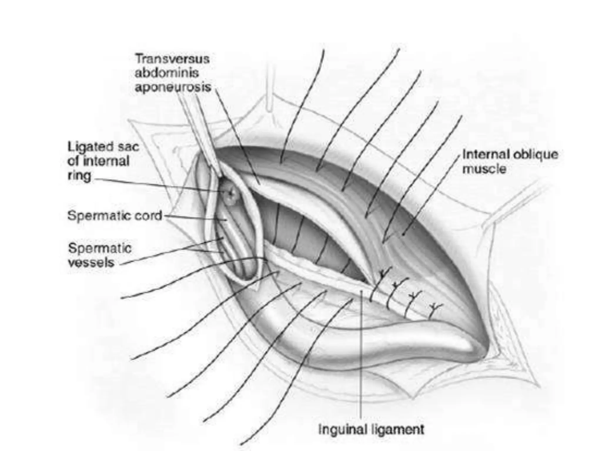 Inguinal hernia repair | PPTX