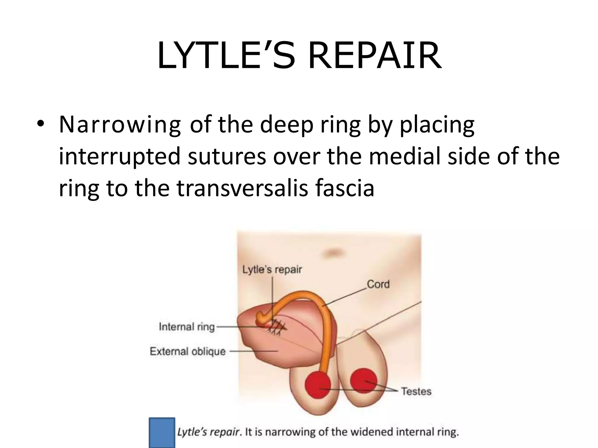 Inguinal hernia repair | PPTX
